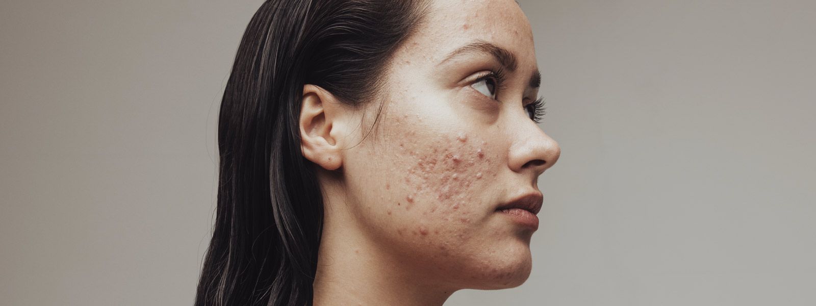 Acne Hormonal: o que é, causas e como tratar | CARE – CARE Natural Beauty
