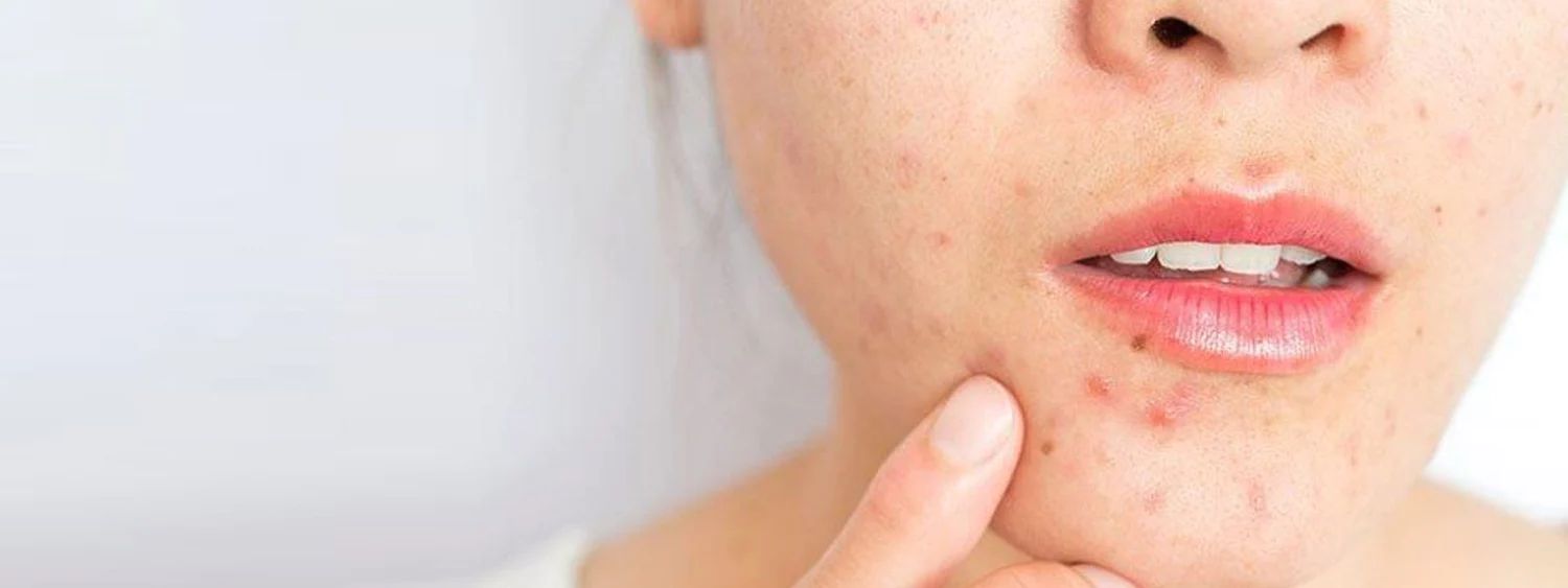 Cravos no rosto: o que são e como tirar? | CARE Blog – CARE Natural Beauty