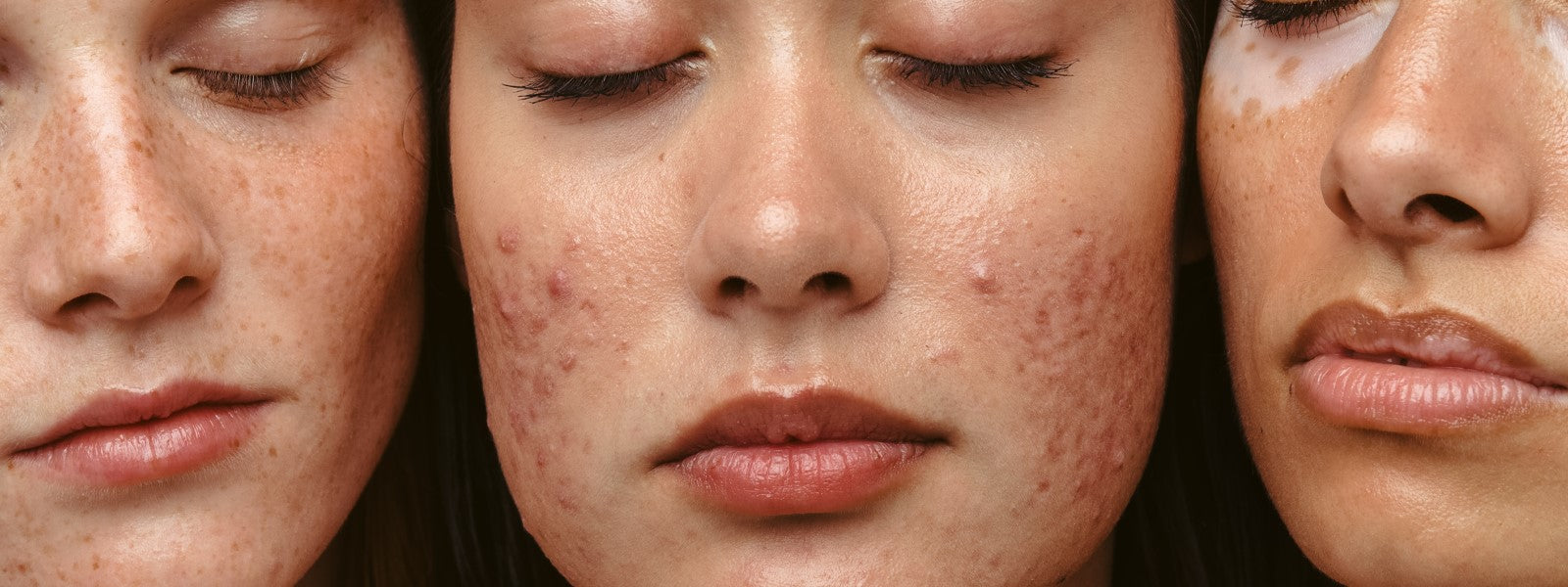 Muitas espinhas no rosto? Causas e como tratar | CARE Blog – CARE ...